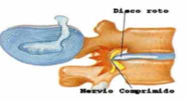 Síndrome Radicular - Clínica Bienestar para tu columna