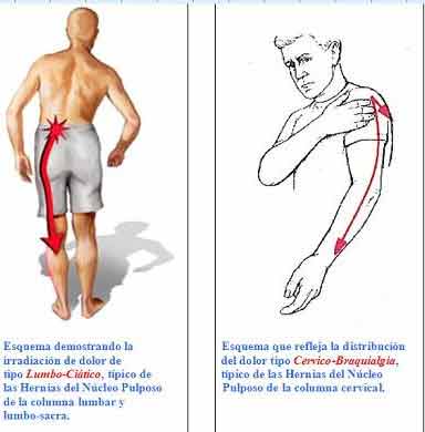 Síndrome Radicular - Clínica Bienestar para tu columna